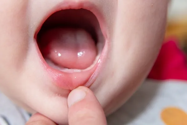 Pediatric Dentist for Lip Tie in Frisco, TX - Dental Smart Kids Dentistry