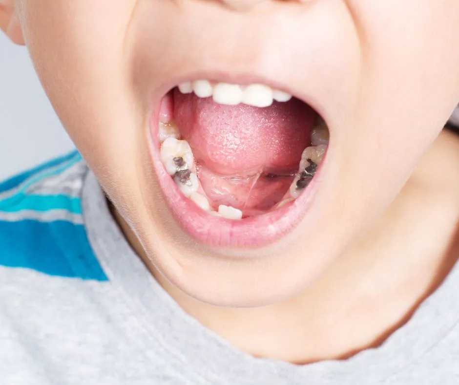 Cavity Treatment For Kids In Frisco, TX - Dental Smart Kids Dentistry